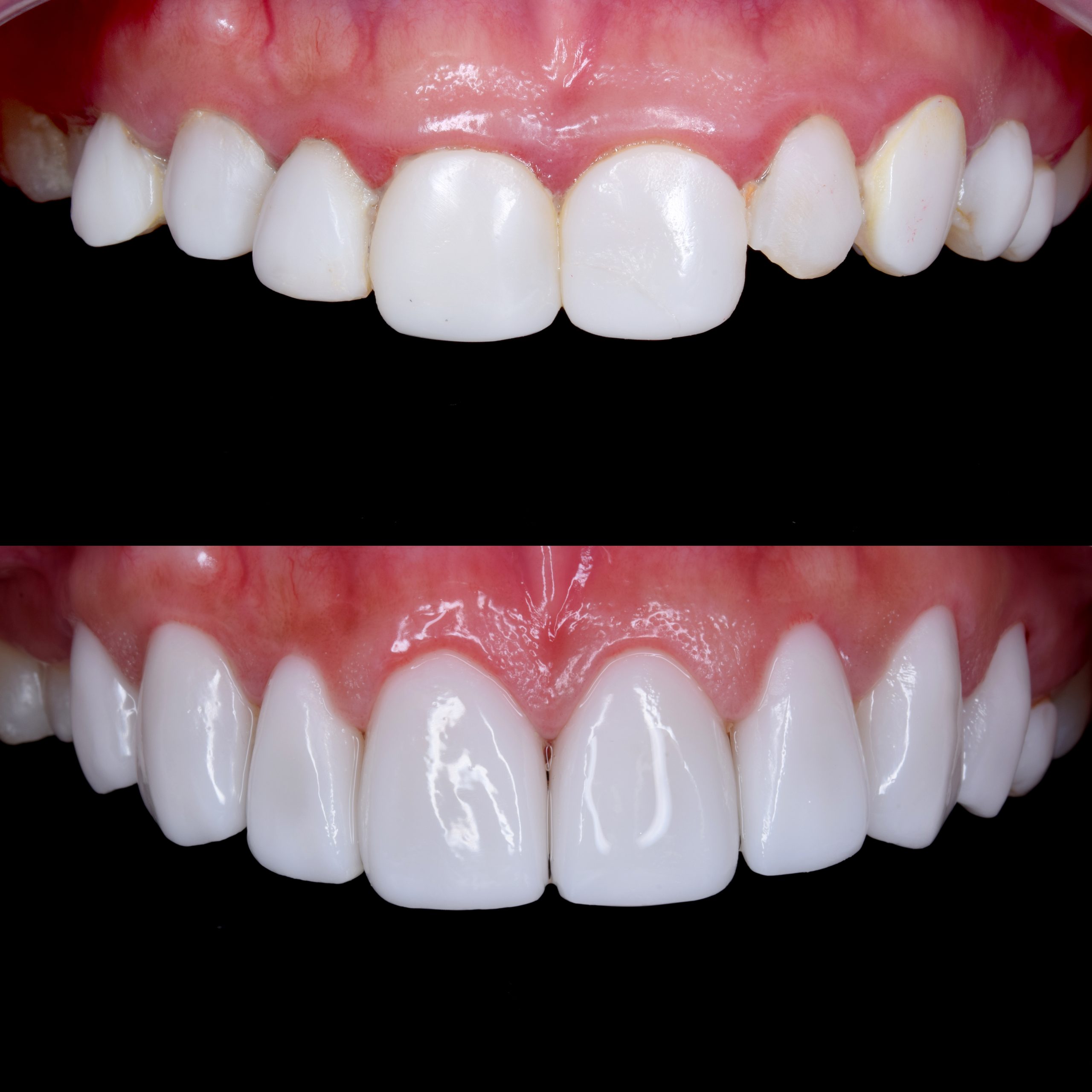 Bulky Veneers vs. Exquisite Porcelain Veneers - SMILE READY BALI