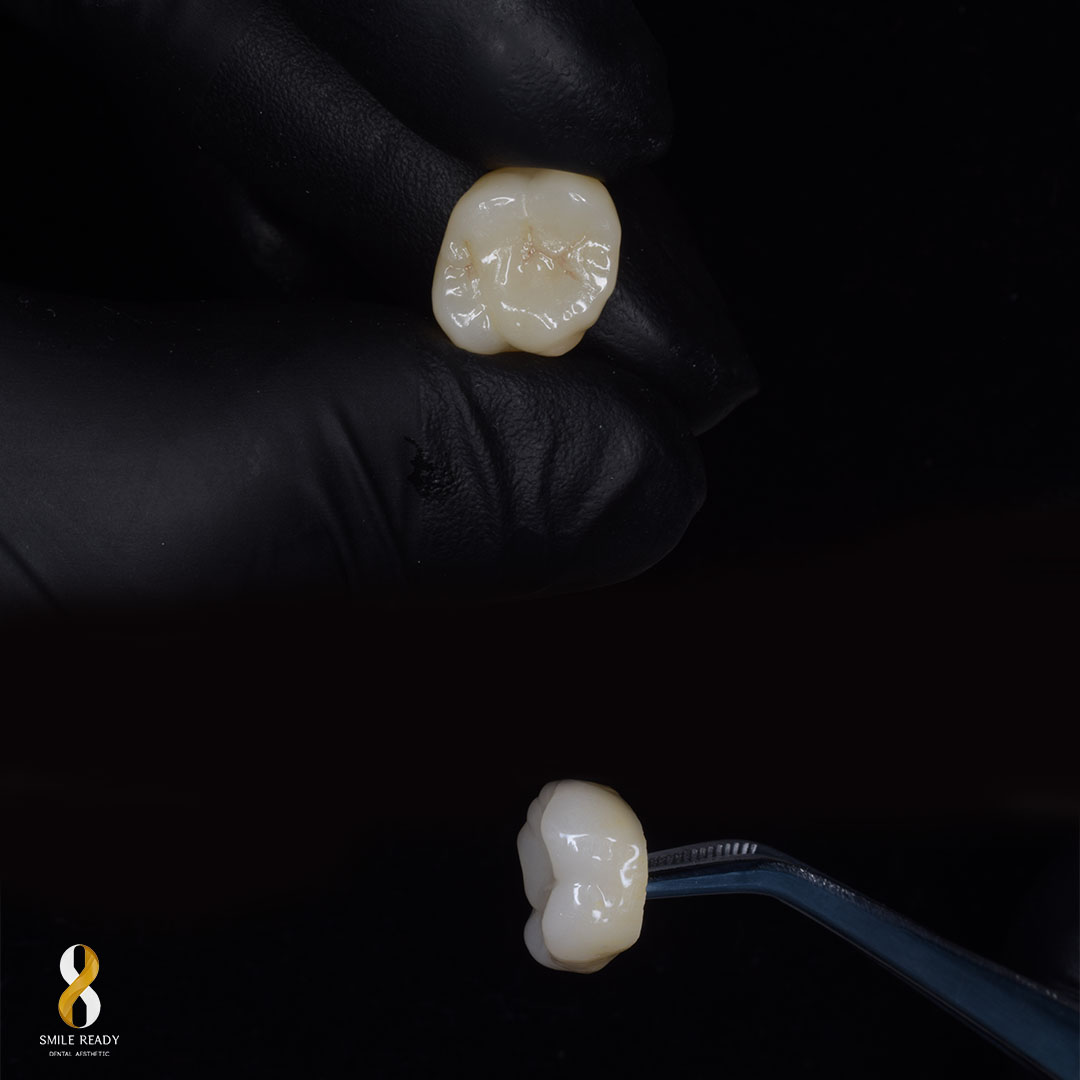 The Essential Role of Crowns in Post-Root Canal Treatment: Restoring ...
