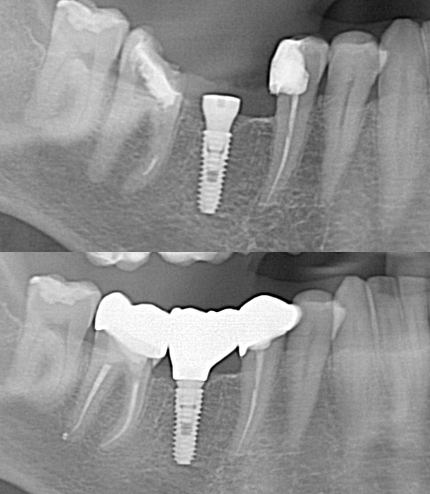 Revolutionizing Smiles: The Magic of Implant Bridges - SMILE READY BALI